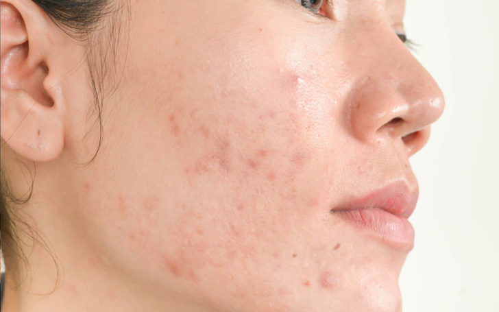 What is Subclinical Acne & How To Treat It | Easy Tips Guide