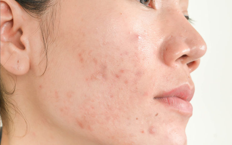 What is Subclinical Acne & How To Treat It | Easy Tips Guide
