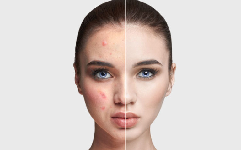 What is Subclinical Acne & How To Treat It | Easy Tips Guide