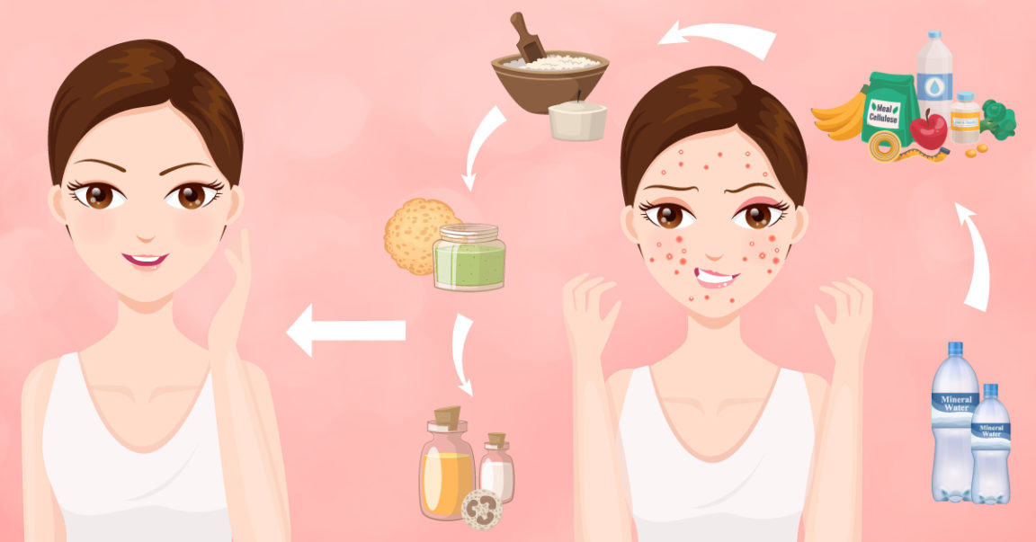 What is Subclinical Acne & How To Treat It | Easy Tips Guide