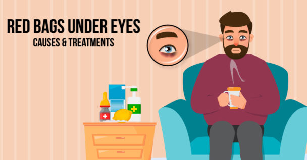 How To Spot Allergic Shiners & Cure Them (Following 5 Ways)