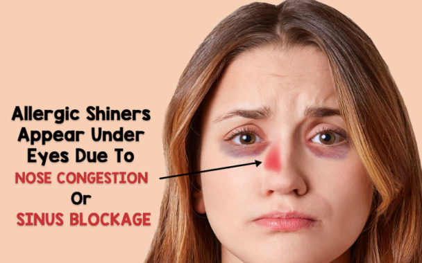 How To Spot Allergic Shiners & Cure Them (Following 5 Ways)