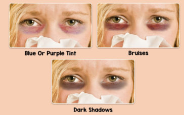 How To Spot Allergic Shiners & Cure Them (Following 5 Ways)