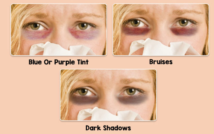 How To Spot Allergic Shiners & Cure Them (Following 5 Ways)