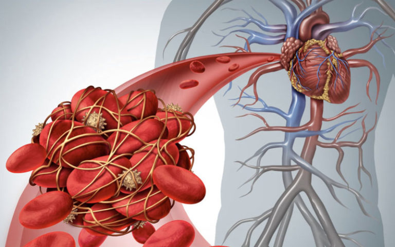 6 Healthy and Natural Blood Thinners (No More Aspirin)