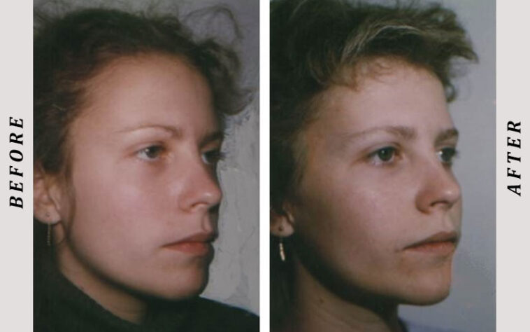 Weak Chin treatments – Exercises, Surgeries, & Makeup Hacks