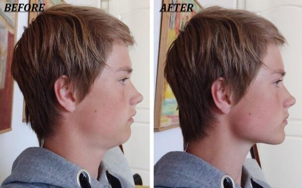 Weak Chin treatments – Exercises, Surgeries, & Makeup Hacks