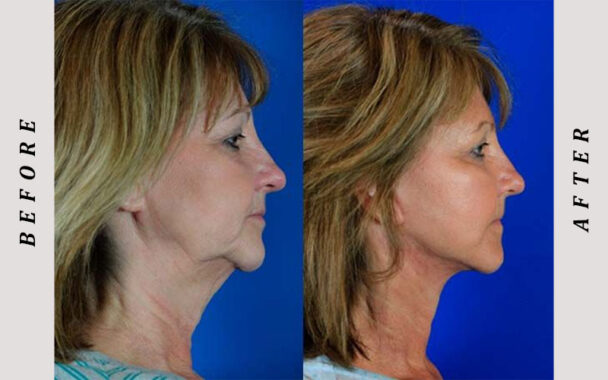 Weak Chin treatments – Exercises, Surgeries, & Makeup Hacks