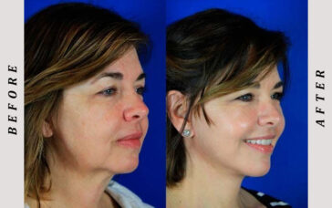 Weak Chin treatments – Exercises, Surgeries, & Makeup Hacks