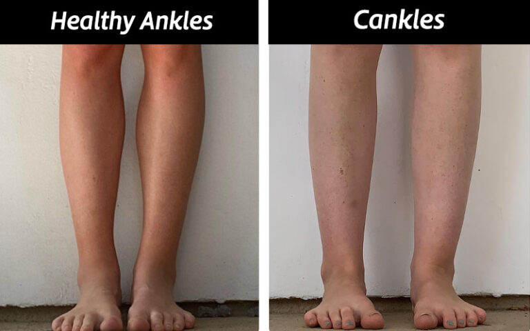 Causes & How To Get Rid of Cankles with Exercise & Surgery