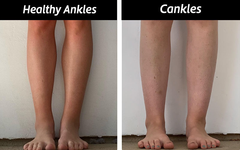 Cankles Cankles