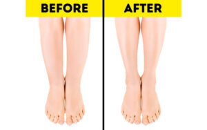 Causes & How To Get Rid of Cankles with Exercise & Surgery