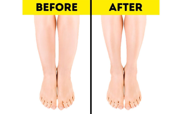 Causes & How To Get Rid of Cankles with Exercise & Surgery