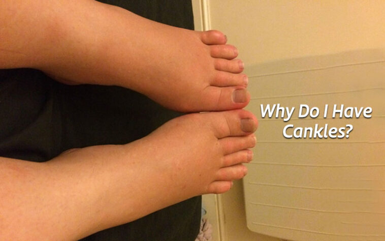 Causes & How To Get Rid of Cankles with Exercise & Surgery