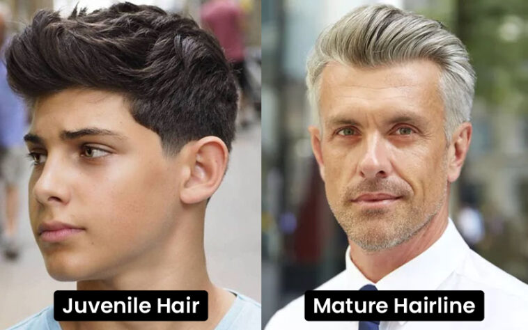 5 Simplest Mature Hairline Treatments To Look Attractive, Confident And ...