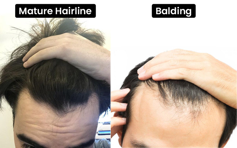 Mature Hairline Vs Widows Peak Viviscal Man My XXX Hot Girl Mature Hairline Vs Widows Peak Viviscal Man My XXX Hot Girl
